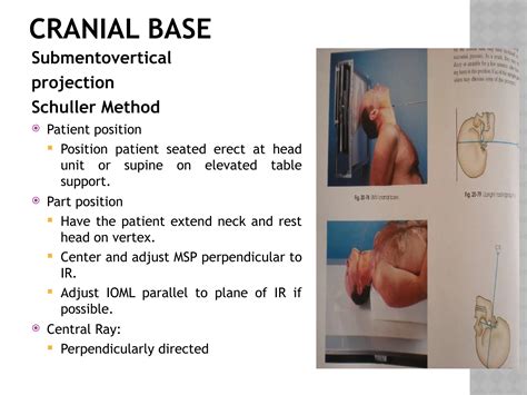 Radiographic Positioning Ii Skull Positioning Pptx