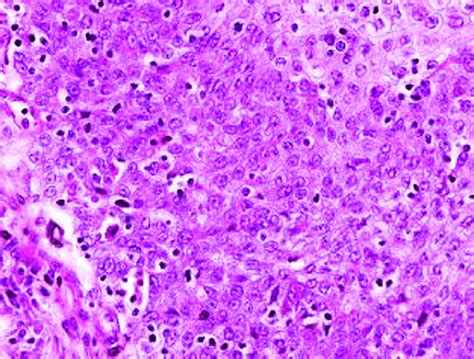 Warty Basaloid Carcinoma Tumor Nest With Uniform Small Cell Features
