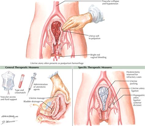Uterine Atony And Postpartum Hemorrhage Clinical Tree