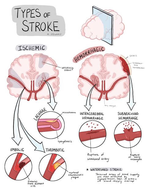 Need A Review Of The Different Types Of Stroke Stroke Can Be Divided Into Two General Categorie