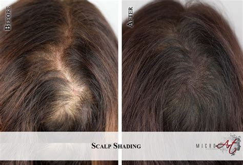 Smp Before And After Transform Your Thinning Hair Today