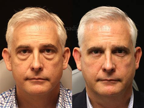 Before And Six Months After Lower Blepharoplasty Surgery And Lower