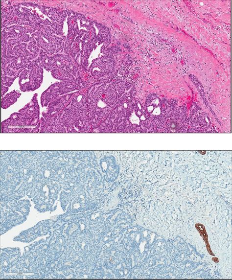 Encapsulated Papillary Carcinoma Semantic Scholar