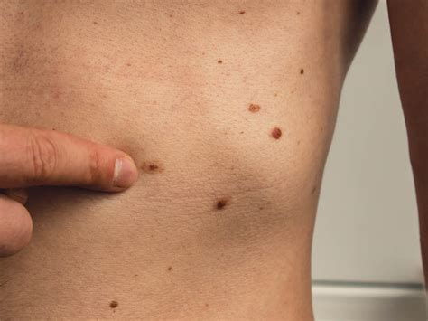 Spot Check How To Check Your Moles For Cancer