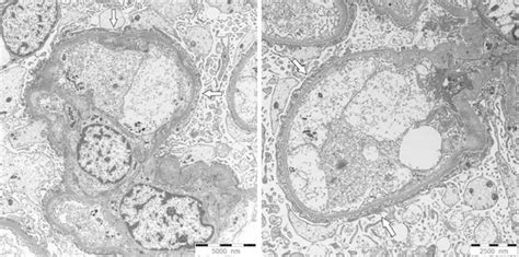 Electron Microscopy Glomerular Capillary Loops With Findings Of
