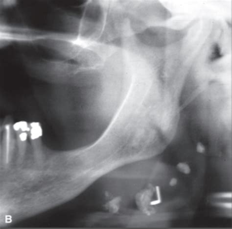 Soft Tissue Calcification Flashcards Quizlet