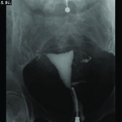 Hysterosalpingogram Prior To Pregnancy Hysterosalpingogram Image