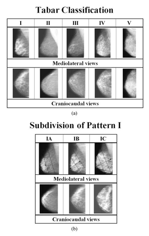 A Tabar Classification Of Types Of Parenchymal Patterns As Seen On