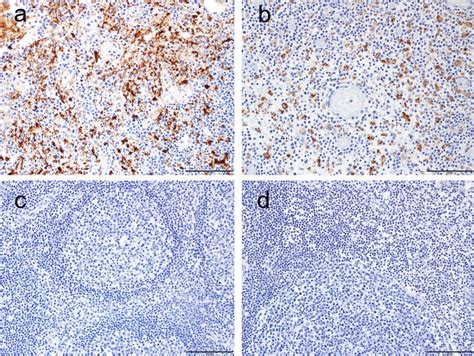 Ihc Staining Of Tracheobronchial Lymph Nodes A Lymph Node From An