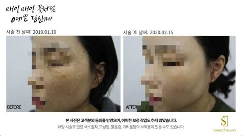 기미치료 전후사진 의사가 알려주는 기미가 치료가 안된다구요 기미없애는법 기미피부과 토닝 【대전 세종 청주 천안