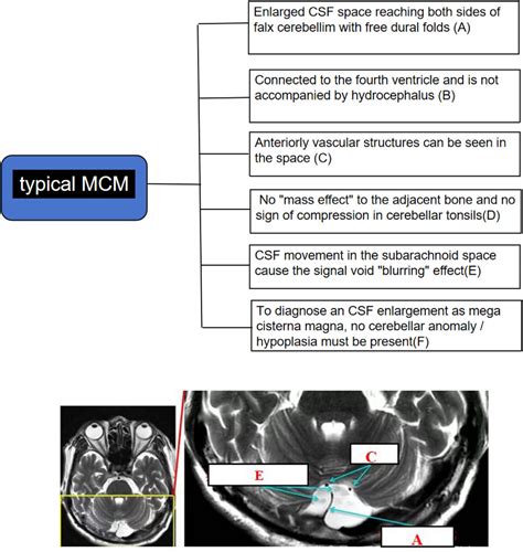 Differentiating Mega Cisterna Magna From Cisterna Magna Arachnoid Cysts