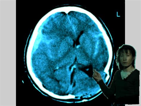 The Annotator Is Pointing At Right To Left Midline Shift In A Head Ct Download Scientific
