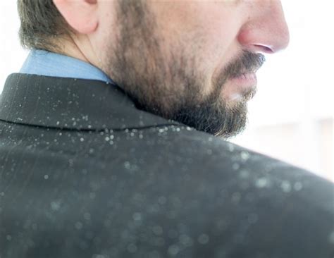 What Causes Dandruff