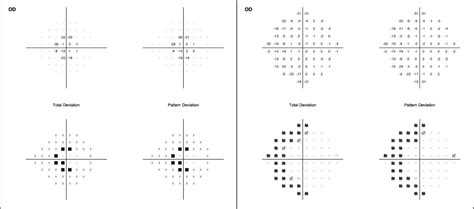 Qualitative Evaluation Of The 10 2 And 24 2 Visual Field Tests For