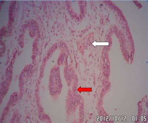 Gross Appearance Of The Left Salpingectomy Specimen With Significant Download Scientific