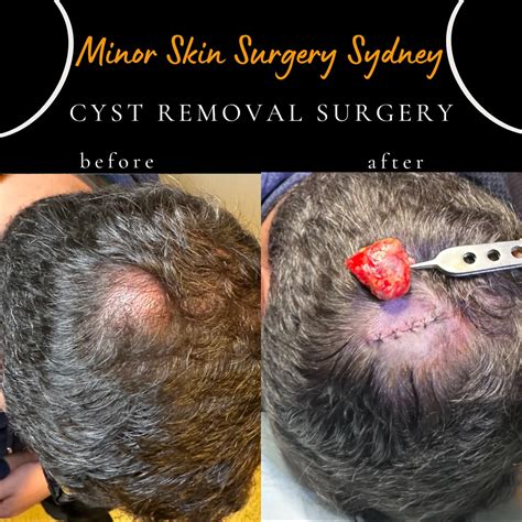 Cyst Surgery Cyst Removal Cyst Treatment Sydney