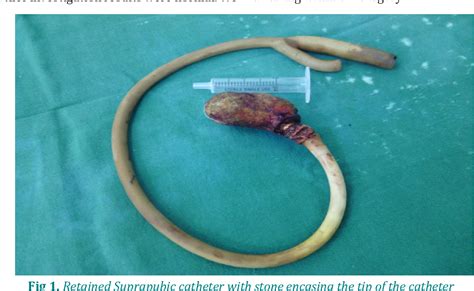 Suprapubic Catheter Foley