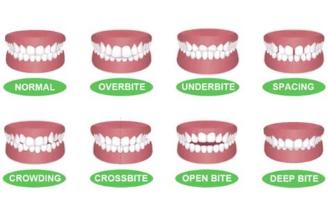 Classification Of Teeth An In Depth Overview