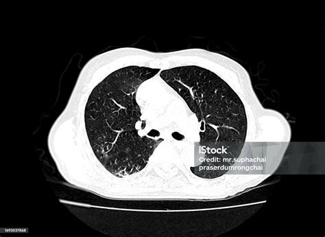 Ct Scan Tampilan Aksial Dada Untuk Diagnostik Emboli Paru Kanker