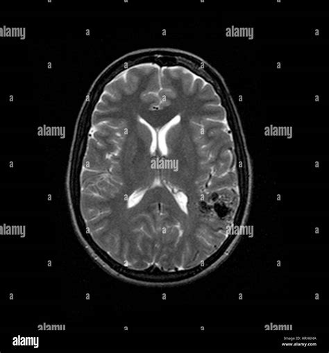 Mri Von Avm Des Gehirns Fotos Und Bildmaterial In Hoher Auflösung Alamy