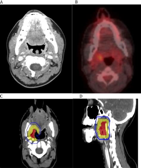 Tonsil Lymphoma