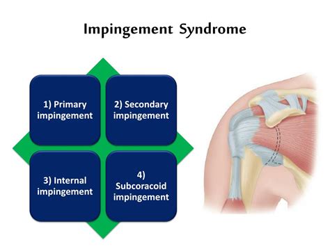 Ppt Impingement Syndrome Powerpoint Presentation Free Download Id