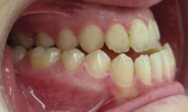 Molar Occlusion Class