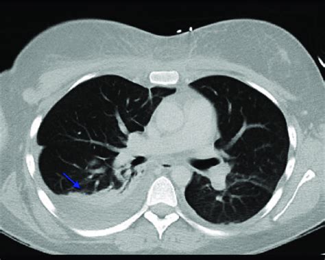Chest Ct With Iv Contrast Reveals Right Basilar Opacification Arrow Download Scientific Diagram