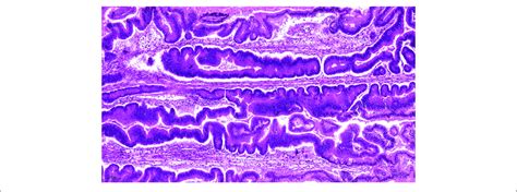 Represents The Lots Of Ectopic Crypt Formation Ecf Showing An