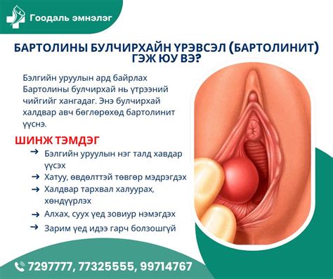 Гоодаль Эмнэлэг Бэлгийн уруулийн үрэвсэл гэж юу вэ Бэлгийн уруулын арьс салст бүрхэвч