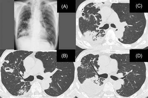 Chest X‐ray Revealed Consolidation In The Right Lower Lung Field And