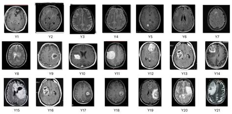 Jpm Free Full Text Brain Tumor Classification Using Meta Heuristic