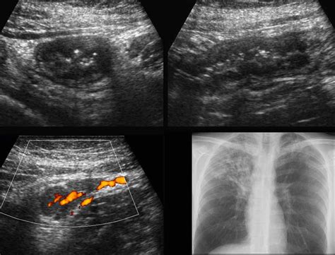 Ileitis Terminalis