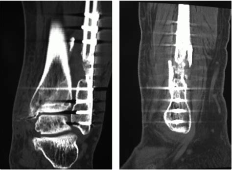 Ilioinguinal Iliohypogastric Block Teachme Orthopedics