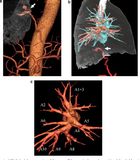 Figure 1 From Utility Of Preoperative Visualization For Intrapulmonary Sequestration In Video