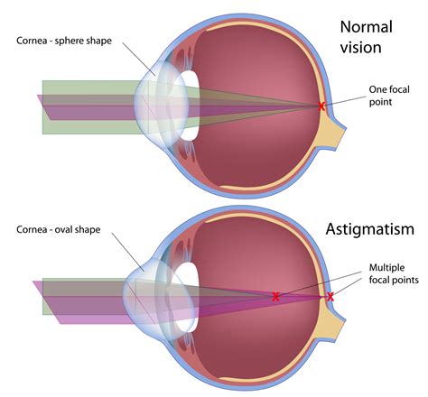 What Is Astigmatism
