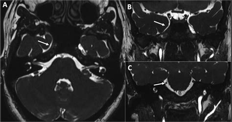 Ciss Images Show The Absence Of Right Meckels Cave Arrow In The Download Scientific Diagram