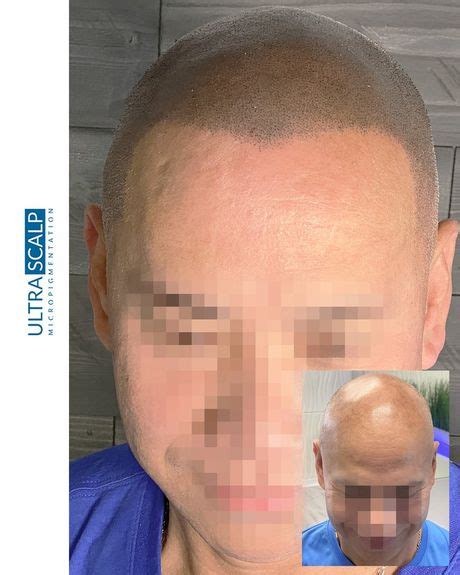 Scalp Micropigmentation Tampa Bay Hair Tattoo Lutz Spring Hill Tampa