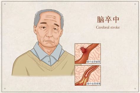 【医资讯】“头等大事”预防脑卒中！第900医院开展世界“脑卒中宣传日”宣传及义诊活动 智业互联（厦门）健康科技有限公司