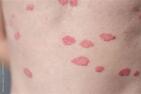 Psoriasis Vulgaris Skin Patches Are Typically Red Itchy And Scaly
