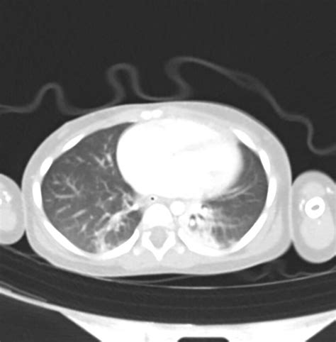 Axial Ct Scan Of The Abdomen Revealing A Subcapsular Hematoma