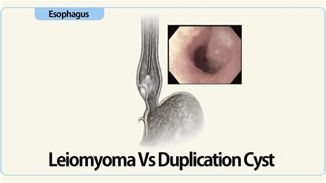 Linear Eus Leiomyoma Vs Duplication Cyst Youtube