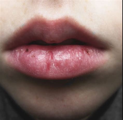 Enfermedades En Los Labios