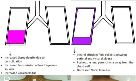 Vocal Fremitus Voice Resonances