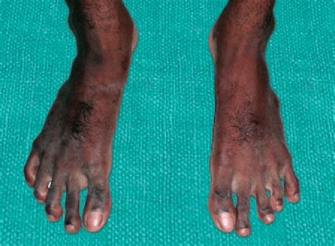 Arachnodactyly Of Toes Download Scientific Diagram