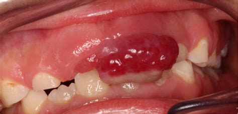 Oral Pyogenic Granuloma Diagnosis And Treatment In Delhi North Delhi