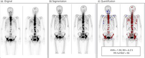 Abnormal Bone Scan