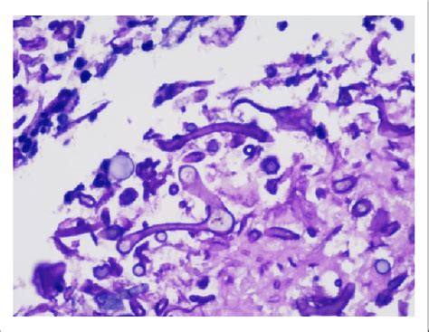 Biopsies Performed During Endoscopic Ethmoidectomy Periodic Download Scientific Diagram