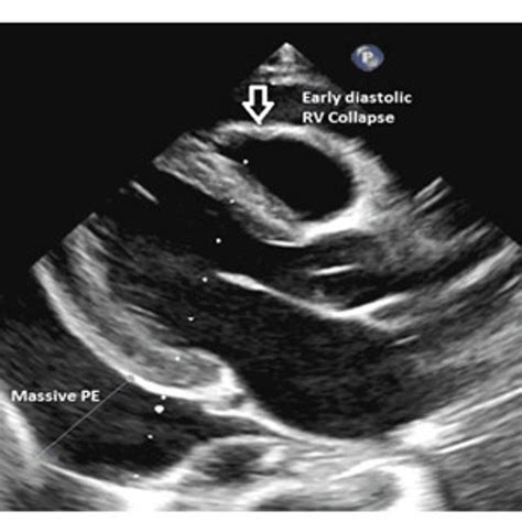 Initial Echocardiography Showing Massive Pericardial Effusion And Early