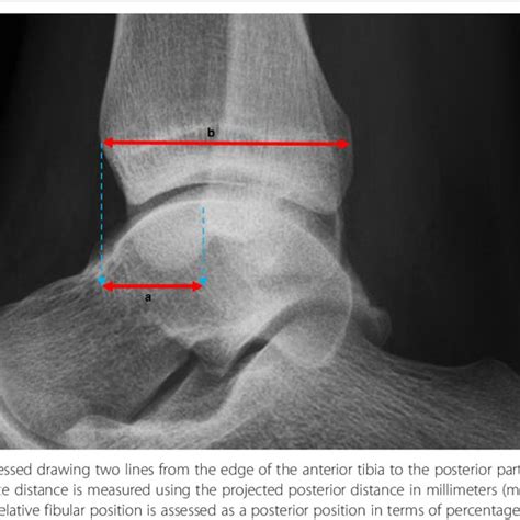 The Talar Convexity Angle Tca Is Formed By Connecting The Posterior